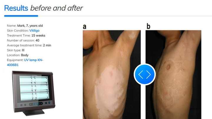 Clinic Kernel UVB Machine PUVA UV Light Lamps 311nm UVB Phototherapy ...