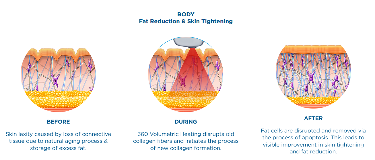 Body Skin Tightening Machine For Professional Use: 360° Collagen ...