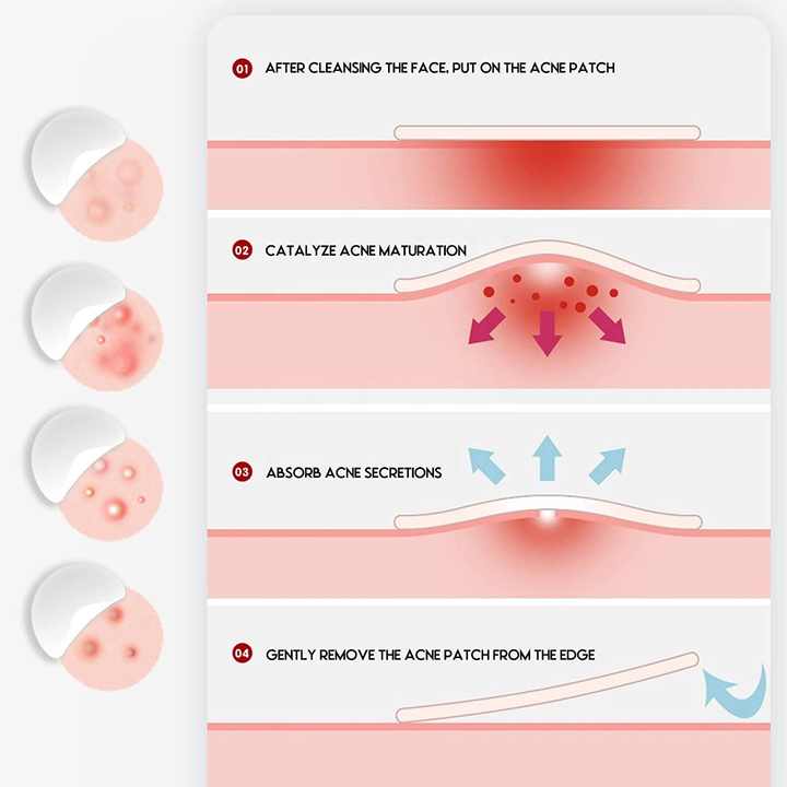Invisible Hydrocolloid Acne Pimple Cover Patch - 36, 72, 108 Count