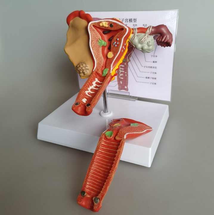 KyrenMed Pathological Model of the Female Genital Organs Human Uterus ...