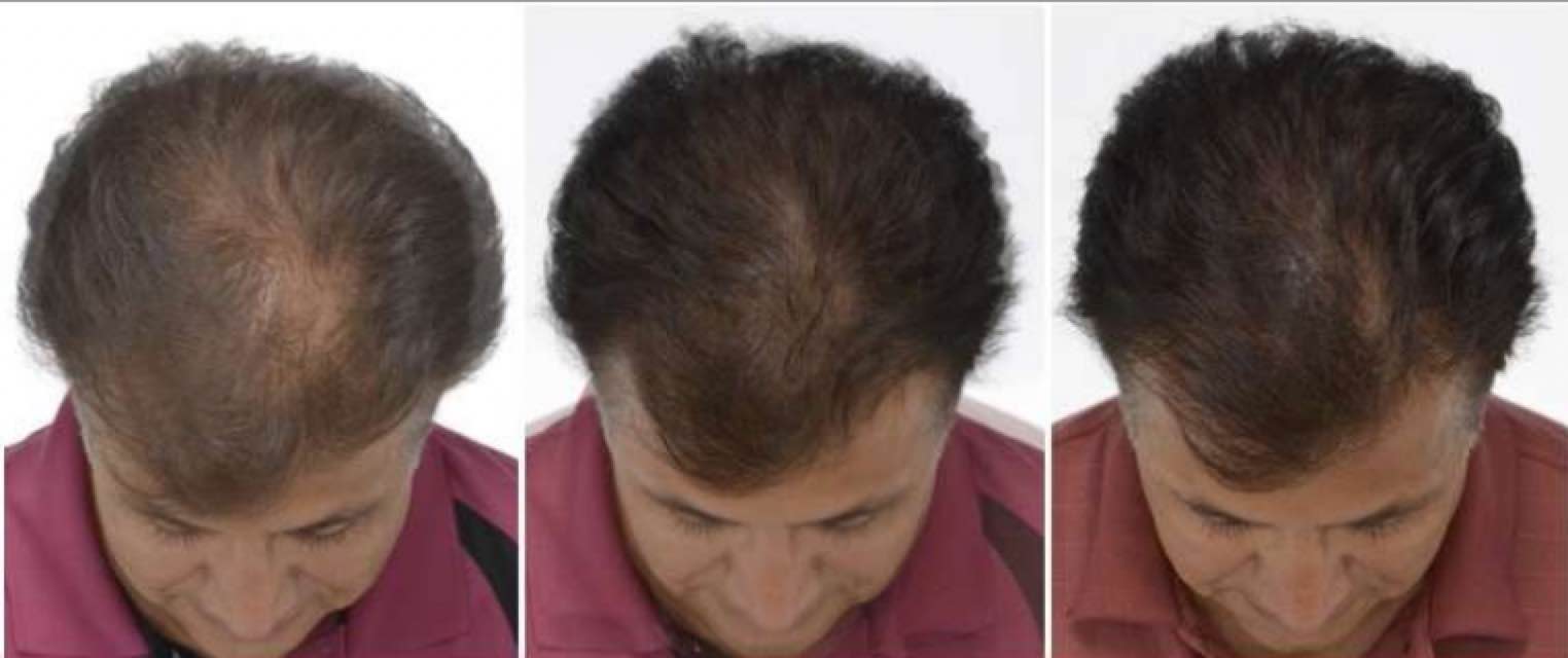 Advanced Laser laser hair growth device with Diode Technology for Hair ...