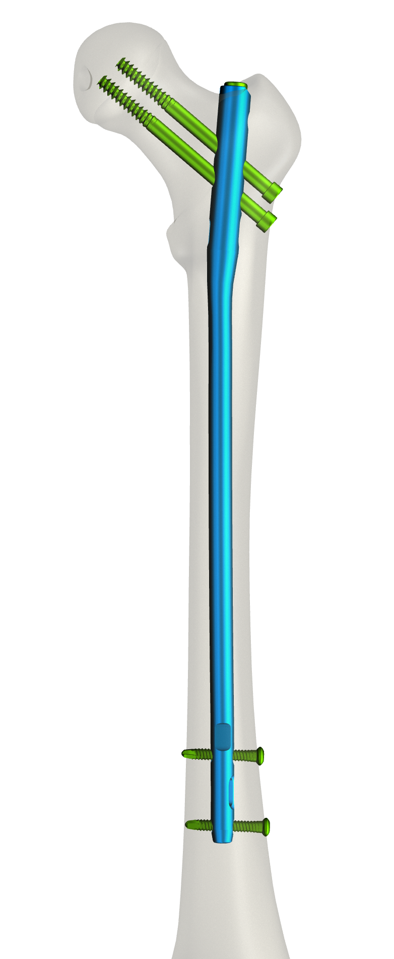 How to Choose the Best Polyaxial Screw Implant: A Complete Buyer's Guide