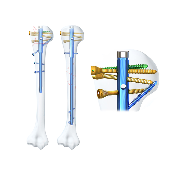 Geasure Orthopedic Implant Titanium Alloy CE Certified Class III Multi ...