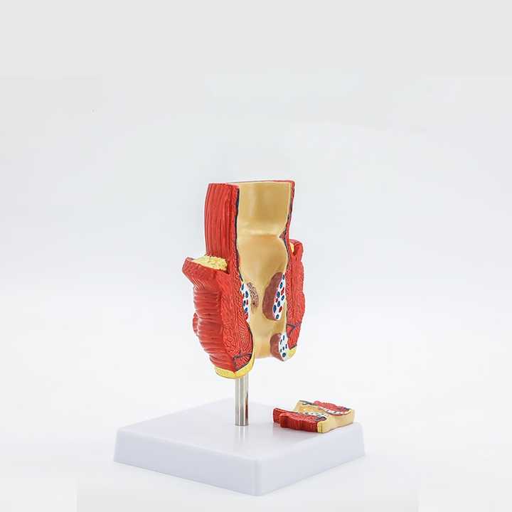 Rectal Hemorrhoids Colorectal Disease Model Internal And External