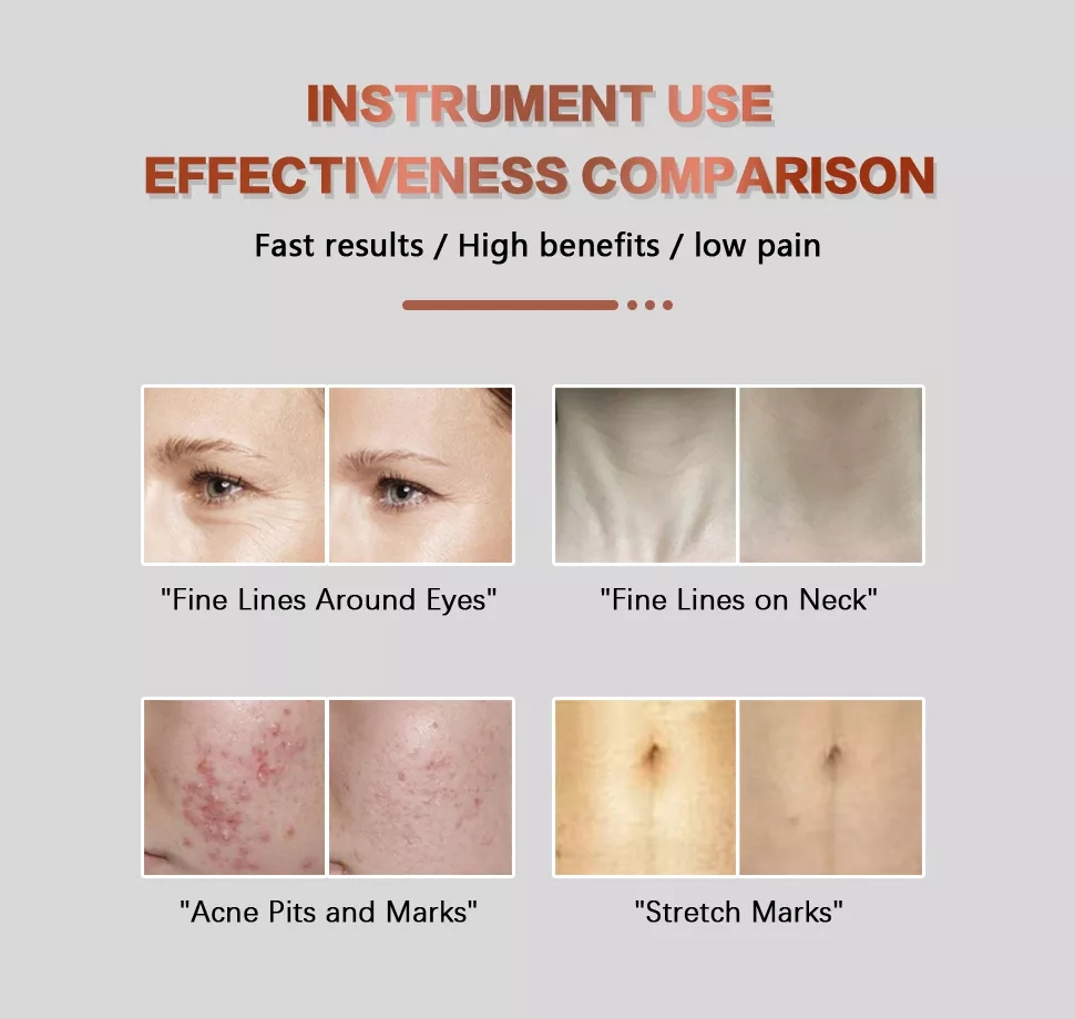 2 in 1 fractional rf microneedling machine for skin body lift - Honkay