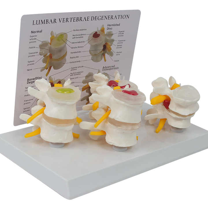4 Stage Customized Human Vertebrae Degeneration Model - Anatomical ...