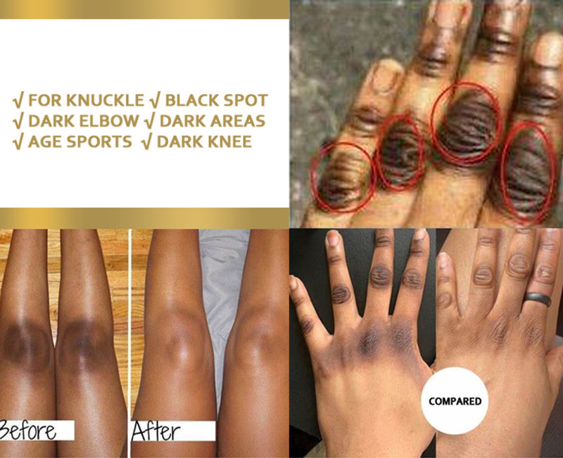 Dark Knuckle Whitening Oil Private Label OEM/ODM Pigmentation ...