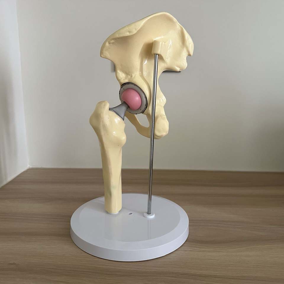 KyrenMed Hip Implant Model Artificial Hip Joint Replacement Model Life ...