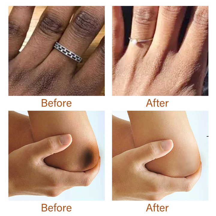 Dark Knuckles Whitening Serum - Intense Stains Remover
