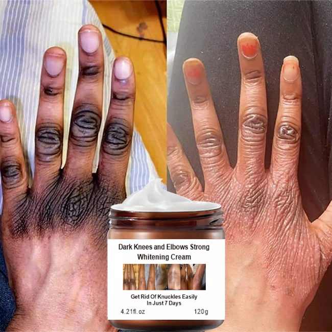 New Arrival Niacinamide Dark Knees Knuckles Elbows Armpit Whitening ...