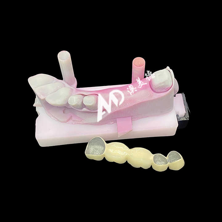 Reliable Porcelain Fused to Metal PFM Dental Bridge for Functional and ...