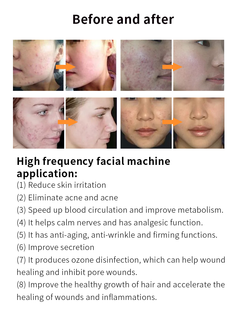 High Frequency Neon Device - Derma Roller Systems SA